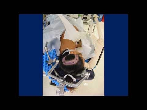 Video 2 8 Transsuperior Temporal Sulcus Approach to Left Temporal Glioblastoma