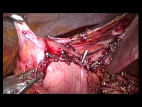 Laparoscopic Lysis Of Adhesions And Redo Of Gastrojejunostomy After Gastric Bypass
