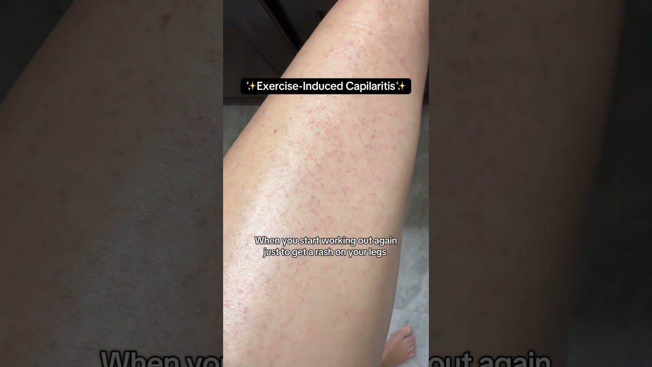 Why You Get Red Spots on Your Legs After Running 🏃‍♀️ | Dermatologist Explains