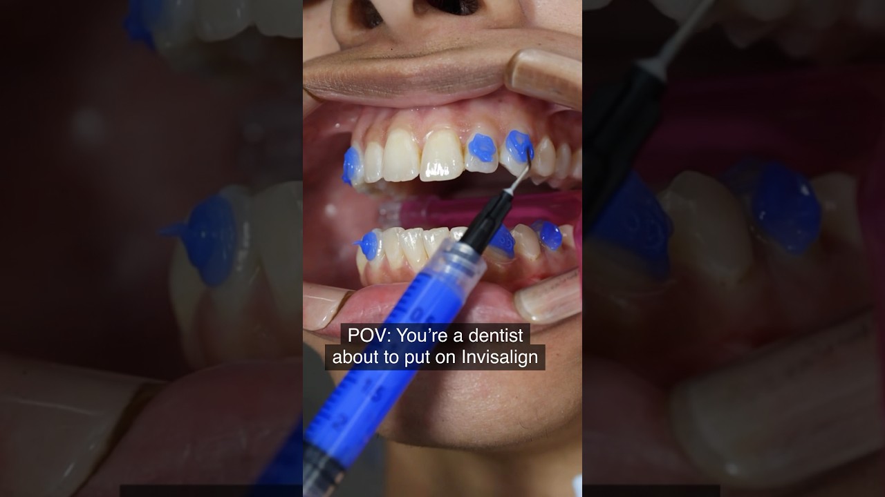 Invisalign attachments