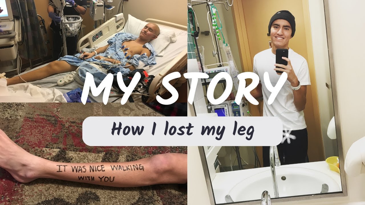 A Journey Through Cancer: How I Lost My Leg and Found My Strength ...