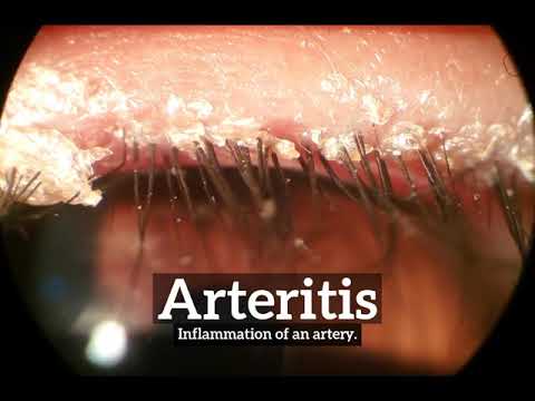 How Does Arteritis Look? | How to Say Arteritis in English? | What is Arteritis?