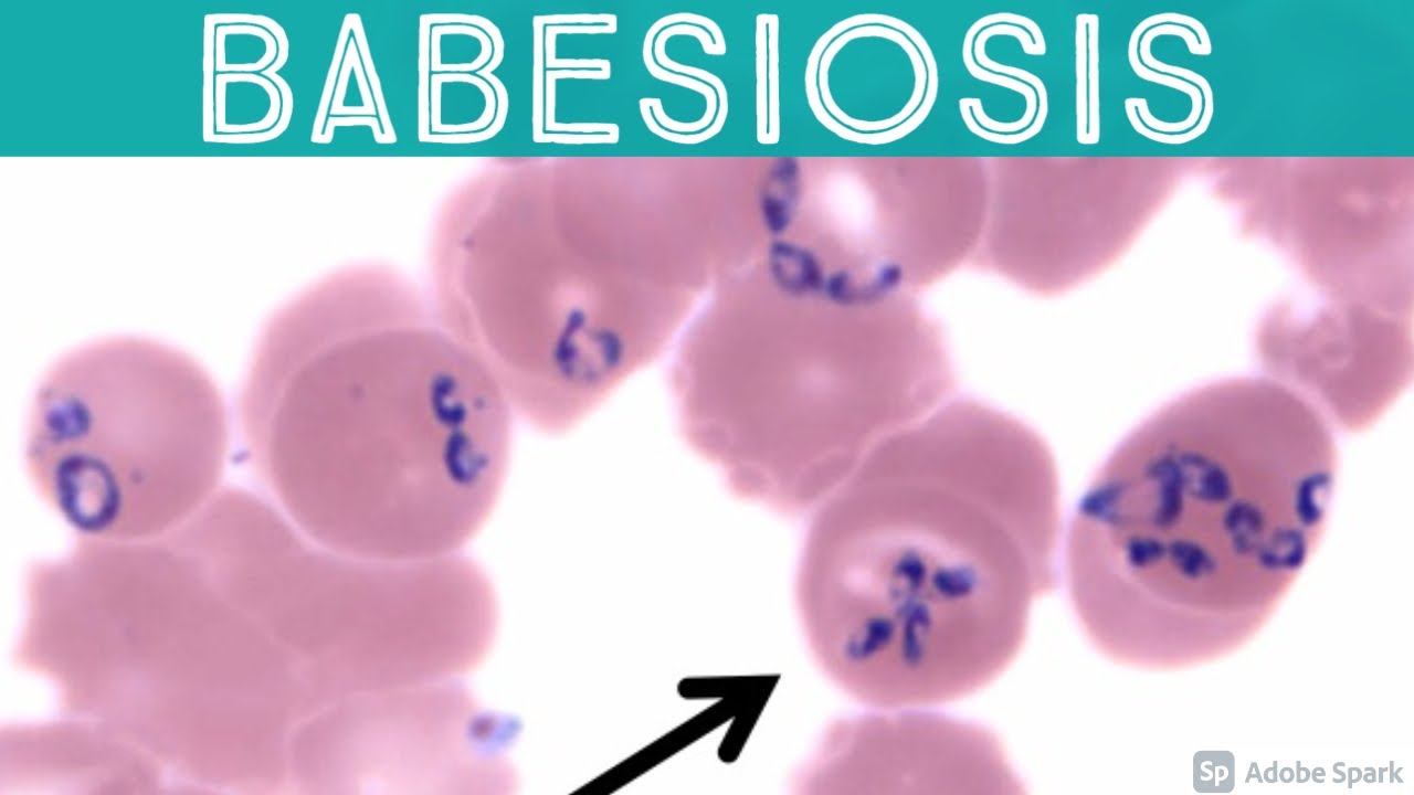 Tick Borne Illness: Babesiosis (Babesia microti) (tetrad Maltese cross) Parasitology Microbiology