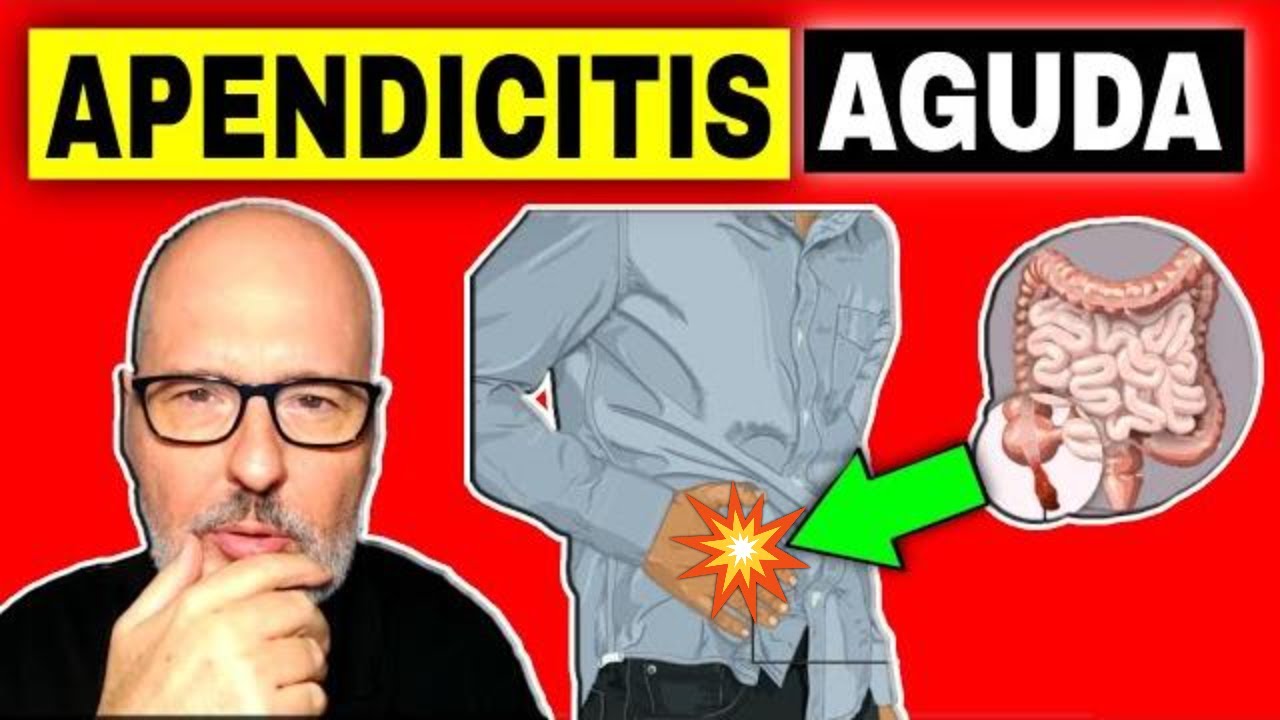APENDICITIS AGUDA: Síntomas, Causas y Tratamiento
