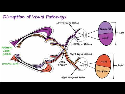 Visual Neural Pathways and Visual Field Defects