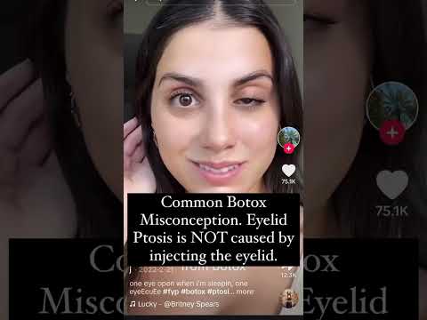 It’s a common misconception that eyelid Ptosis from Botox is caused by injecting the eyelid #botox