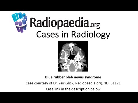Blue rubber bleb nevus syndrome (Radiopaedia.org) Cases in Radiology
