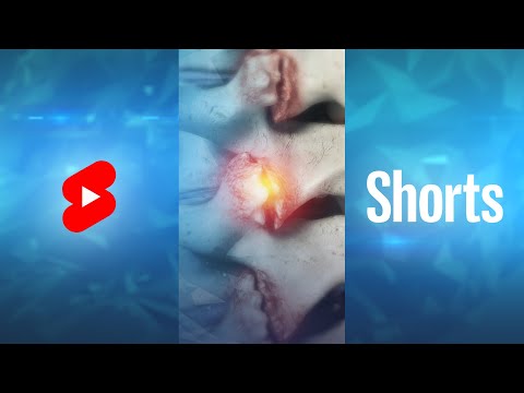 What is Facet Joint Syndrome? #Shorts