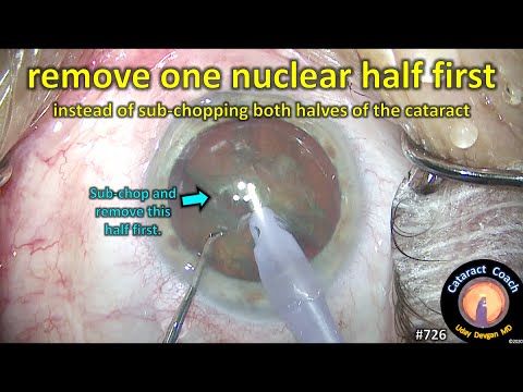 remove one nuclear half first in cataract surgery