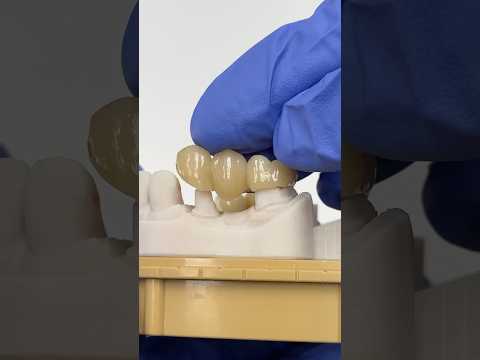 Pontic Bridge with Temporary Crowns #lsk121shorts #dentist #teeth