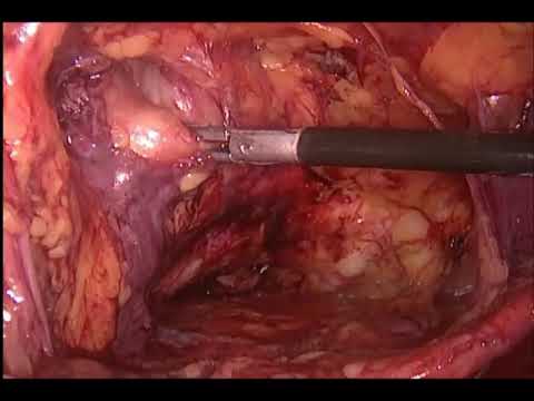 Laparoscopic inguinal hernia surgery(TAPP) for incarserated Appendices Epiploicae