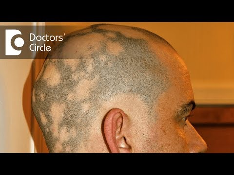What Is alopecia areata? - Dr. Shuba Dharmana