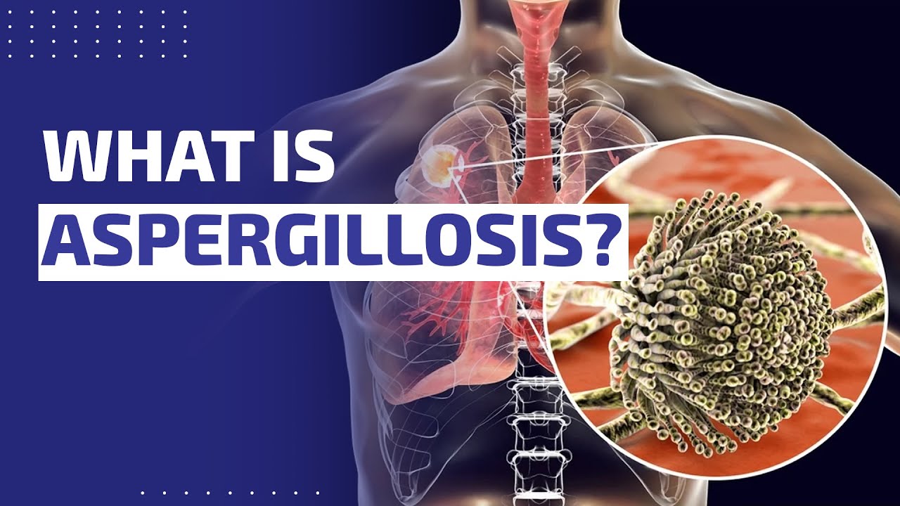 ASPERGILLOSIS - CAUSES, SYMPTOMS & TREATMENT