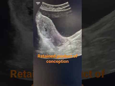 Retained product of conception RPOC #ultrasound #usg3d