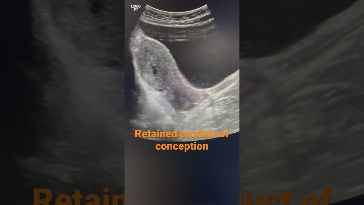 Retained product of conception RPOC #ultrasound #usg3d