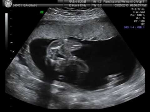 20 Week Ultrasound - Baby Boy!