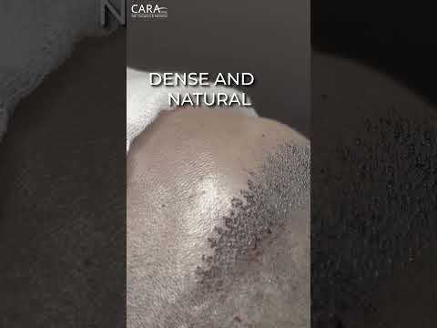 How Hair Transplant Works | Hair Transplant Timelapse