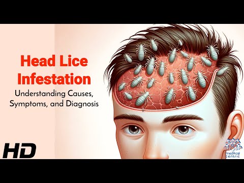 Head Lice Infestation: From Cause to Cures