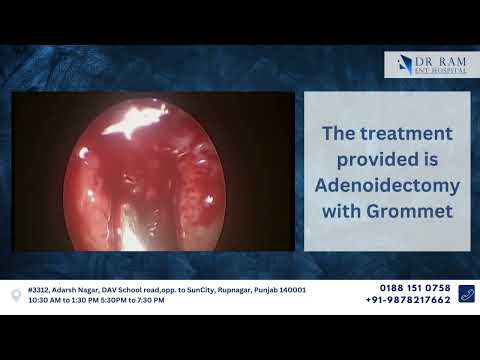 Adenoidectomy with Grommet Surgery