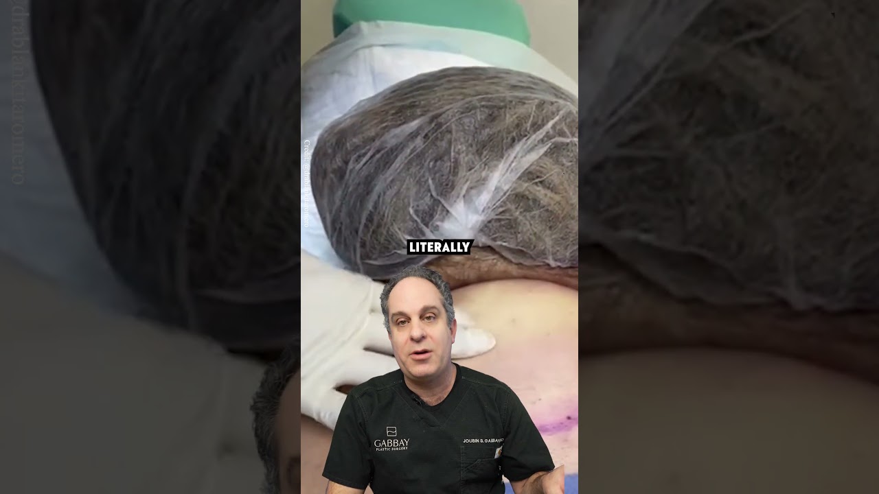 BUFFALO HUMP LIPOSUCTION! #plasticsurgeon #viral #buffalohump #buffalo
