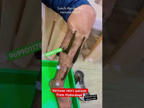 Do leeches help with varicose veins? What are the side effects of leech therapy? #kzhijama July 2023