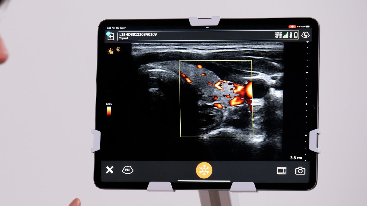 Power Doppler Imaging