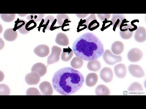 Döhle Bodies present on peripheral blood smear (Hematopathology & Hematology)