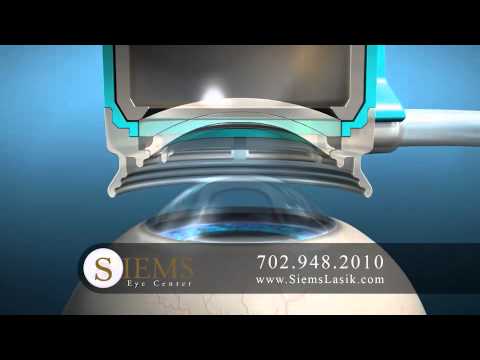Dr. Jon Siems - most trusted cataract surgeon