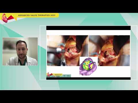 N. Spilias | TAVR optimization with AI and the role of simulations