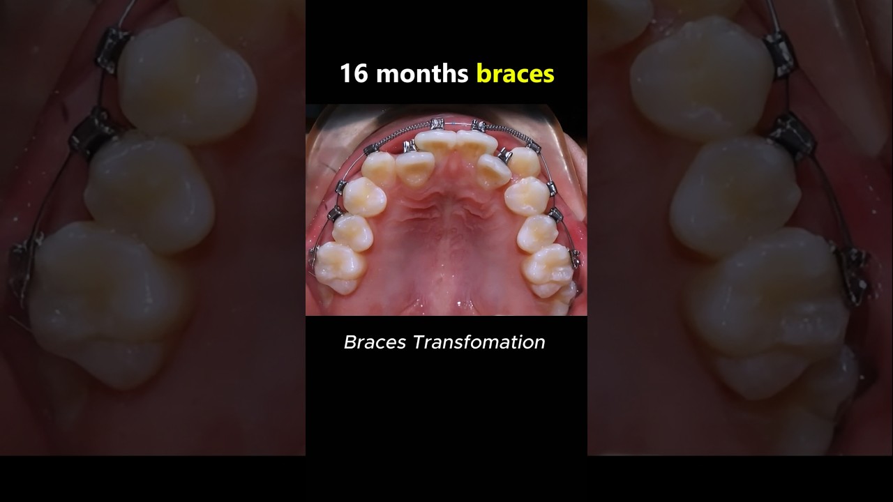 Braces journey:  16 months duration. Fix crooked teeth #dentist #braces #orthodontist