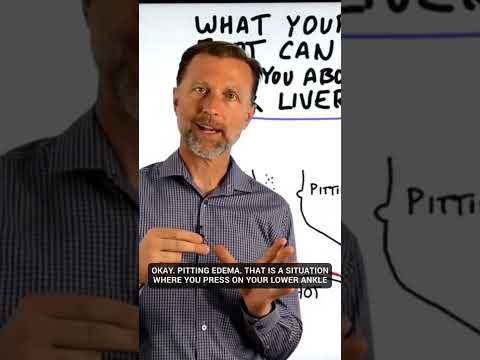 Pitting Edema and Your Liver #drericberg #liver #pittingedema #feet #health