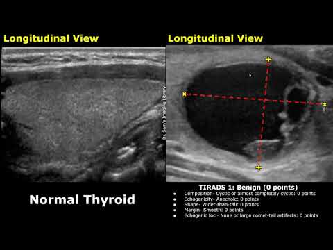 ACR TIRADS Classification Of Thyroid Nodules Ultrasound | Thyroid Imaging Reporting and Data System