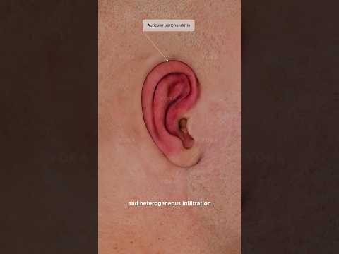 What is perichondritis of the auricle and why should you care? Explained in 3D