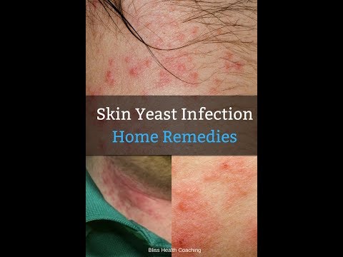 Candidiasis of the Skin (Cutaneous Candidiasis) | yeast infection on skin home remedy