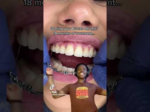 What to Expect After Braces