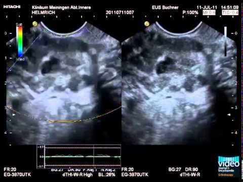 Advanced EUS Imaging for Pancreatic Diseases: CE-EUS (Low-MI, High-MI), Real-Time Elastography, 3D