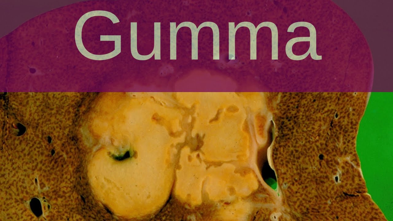 What is a Gumma? - Pathology mini tutorials