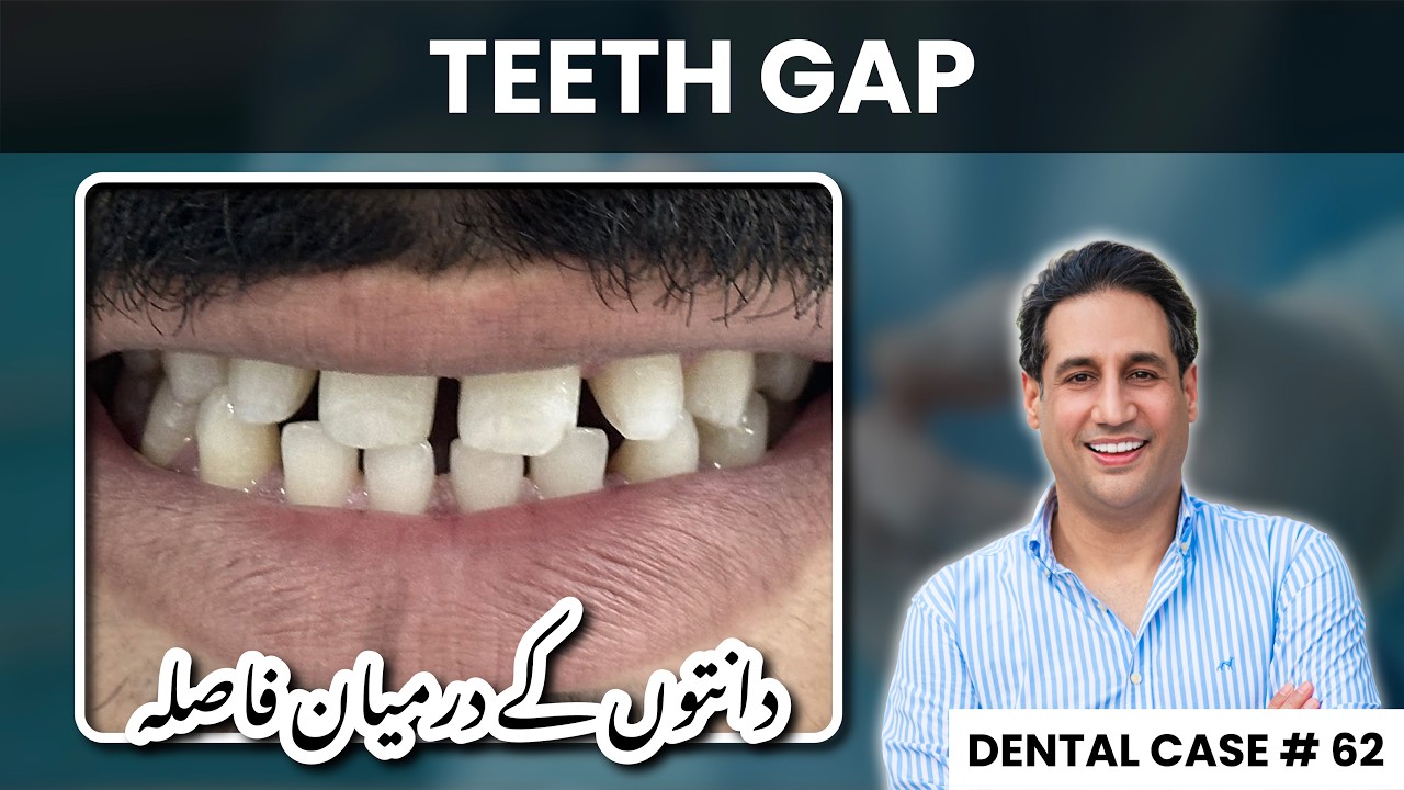 Teeth Gap Treatment Without Braces | Midline Diastema | Spacing Between Teeth | Dental Case # 62
