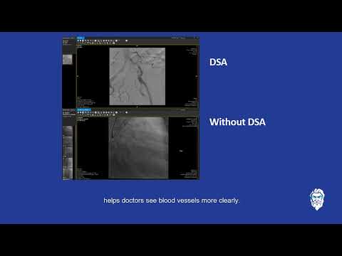 DSA(Digital Subtraction Angiography)-XEUS