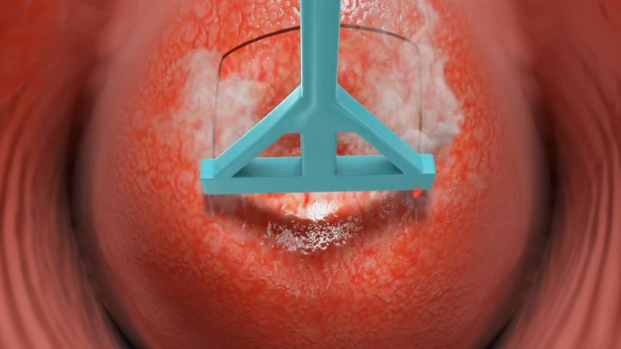Loop Electrosurgical Excision Procedure (LEEP) (3D Animation)