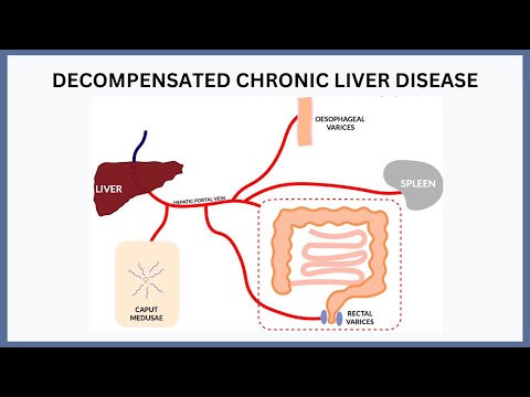 Decompensated Chronic Liver Disease Explained
