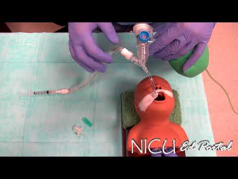Surfactant administration in a preterm infant