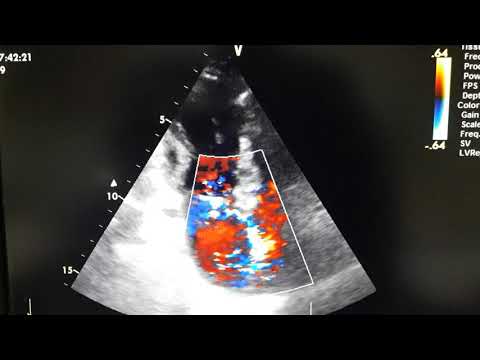What is the severity of MR in this symptomatic pt.