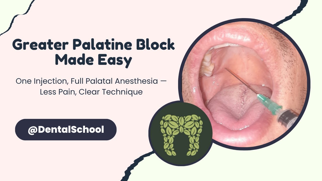 Greater Palatine Nerve Block EXPLAINED | Simple Guide for Effective Palatal Anesthesia