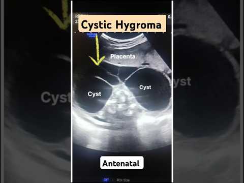 Cystic Hygroma#radiology #baby ##fetus#usg#neet#intrauterine#pregnancy #sonography#uterus#antenatal#