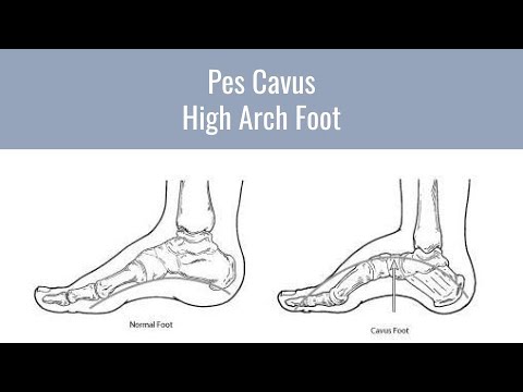 The Best Ways to Take Care of High Arch Feet