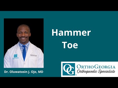 What is Hammer Toe? Orthopaedic Foot and Ankle Specialist, Dr. Ojo, Shares his Expertise