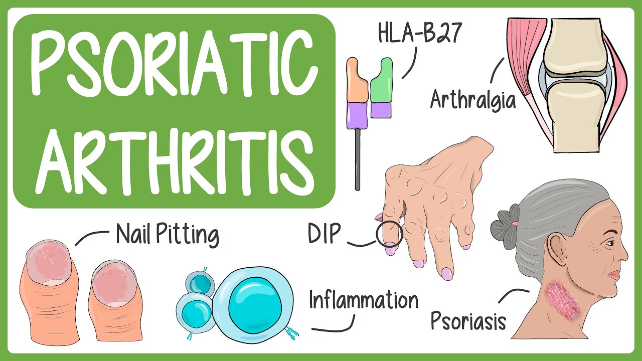 Psoriatic Arthritis Visually Explained