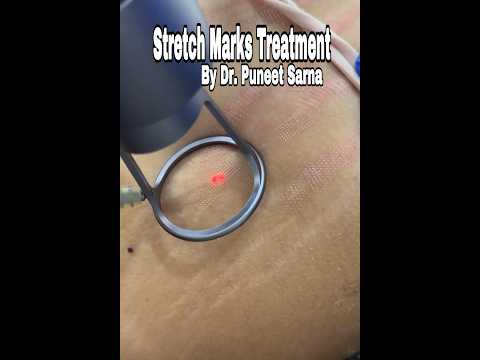 #stretchmarksremoval #lasertreatment #co2laser #drpuneetsarna #skinclinickashipur