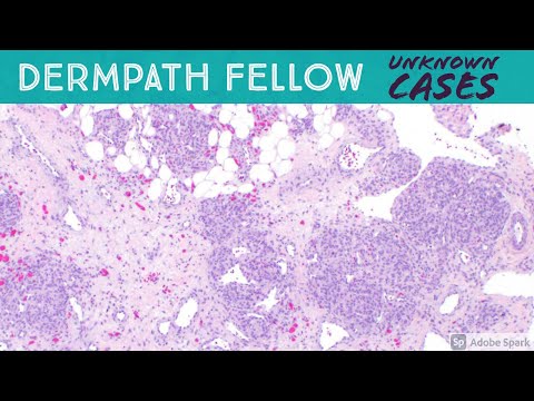 Dermpath Fellow Slide Session: Kaposiform hemangioendothelioma, plexiform fibrohistiocytic tumor etc